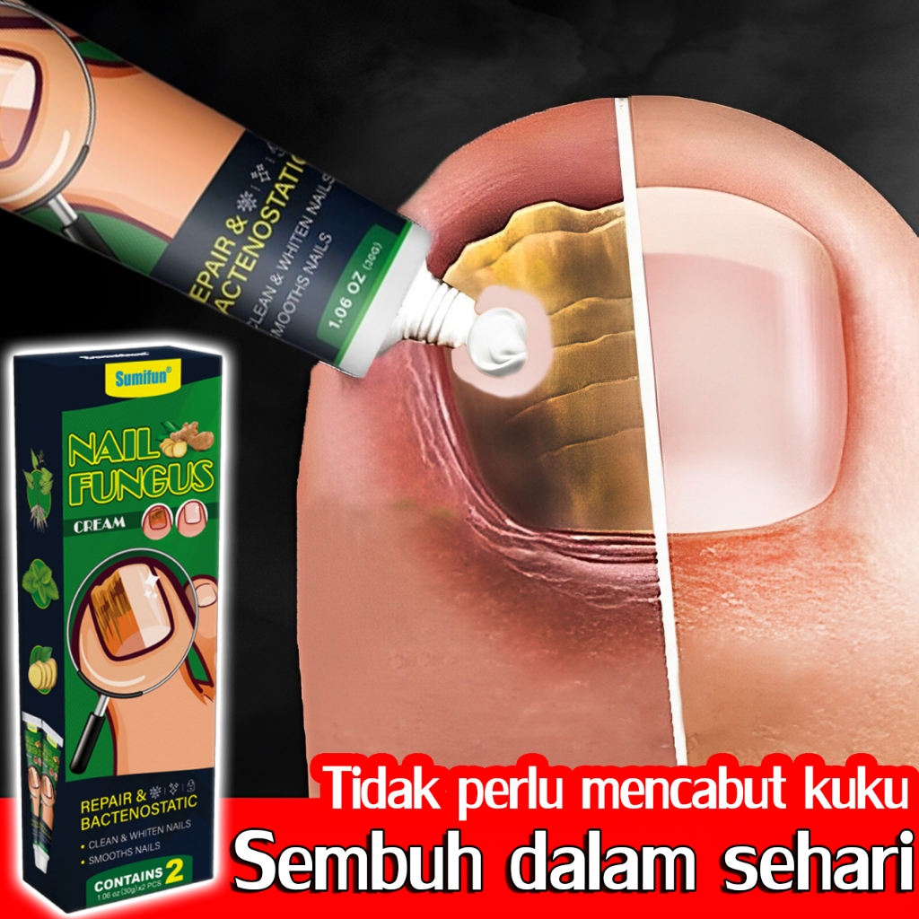 Jual 【2 hari penghapusan】obat jamur kuku,jamur kuku Perawatan Kuku ...
