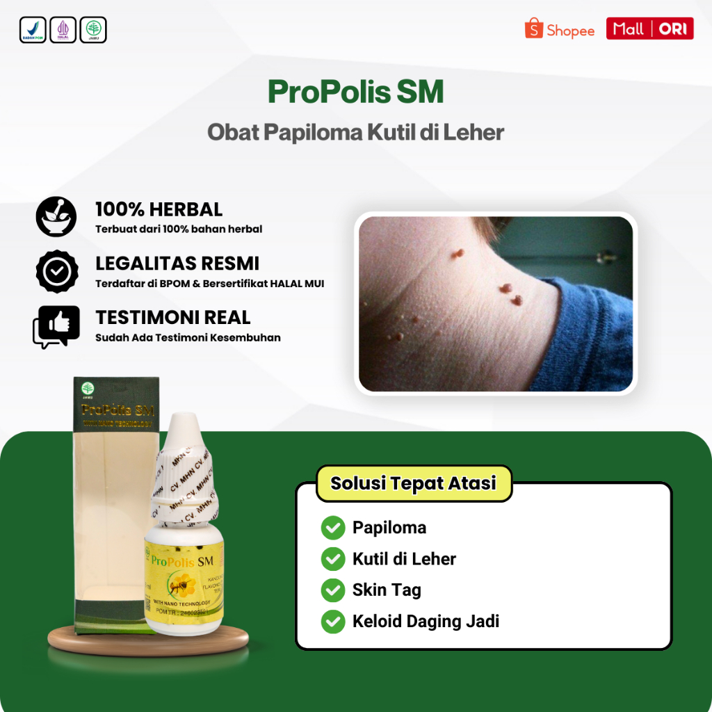 Jual Propolis SM - Obat Kutil di Leher Papiloma, Obat Perontok Kutil di ...
