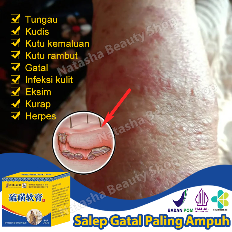 Jual 100% ORI Salep gatal paling ampuh salep gatal selangkangan Salep ...