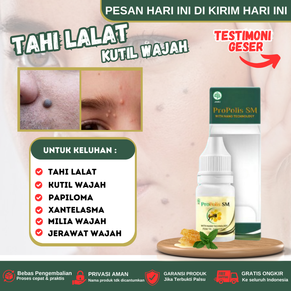 Jual Propolis SM - Penghilang tahi lalat, Obat penghilang tahi lalat di ...
