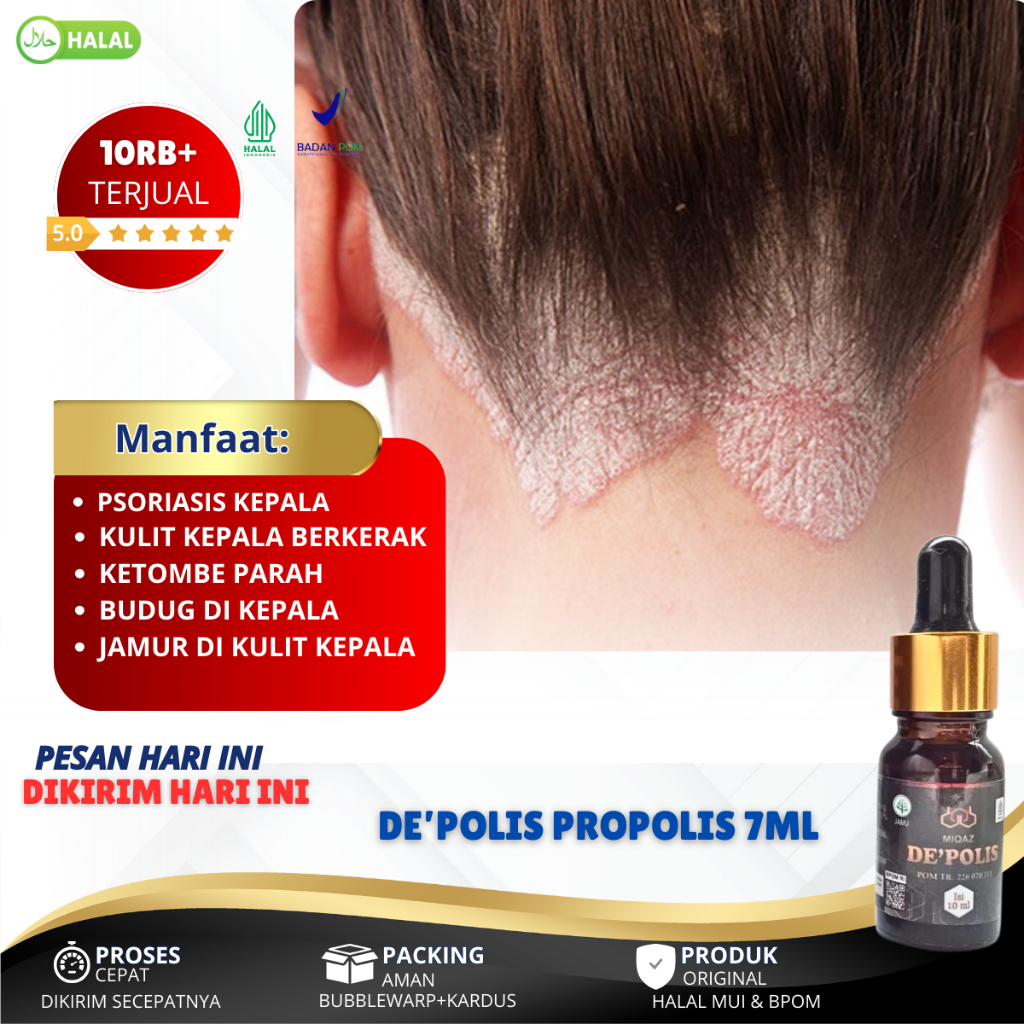 Jual Obat Kulit Kepala Gatal Bersisik Berjamur, Pembersih Kulit Kepala yang Gatal, Psoriasis di ...