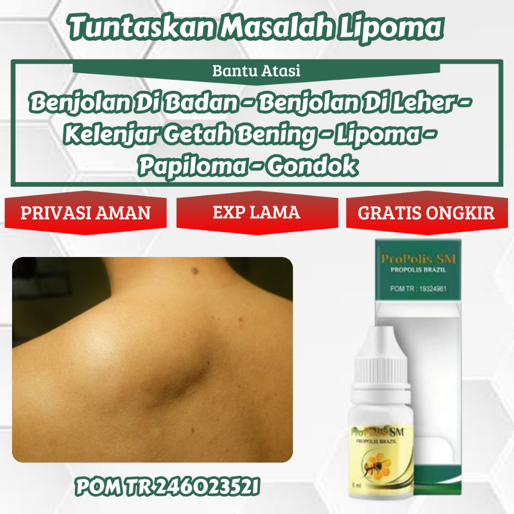 Jual Obat Benjolan Di Leher Kelenjar Getah Bening Lipoma Gondokan ...