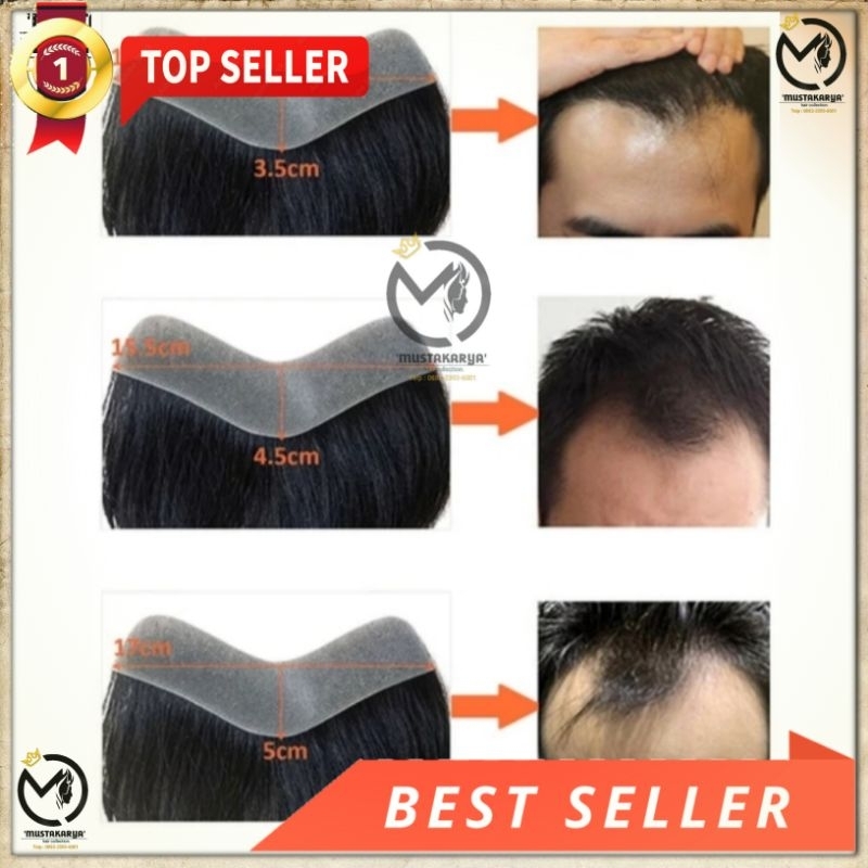 Jual Hair Toupe Toupee Hairline Frontal Pony Botak M Botak Oval/ Tutup ...
