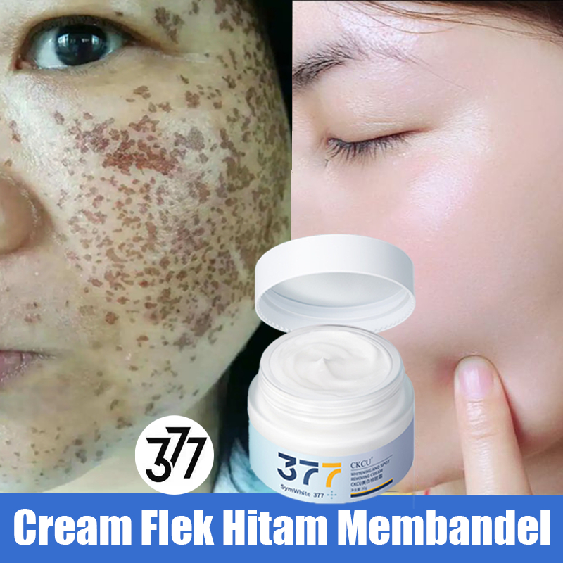 Jual Cream Flek Hitam Membandel 377 Krim Penghilang Flek Hitam ...