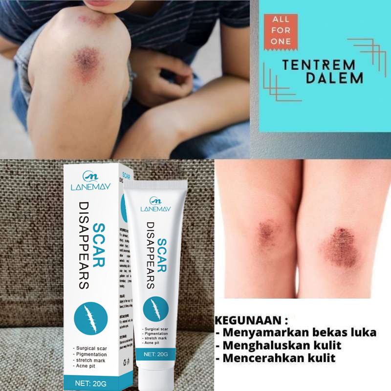 Jual LANEMAY Disappear Skin Tentrem Dalemb Scar Cream Obat penghilang ...