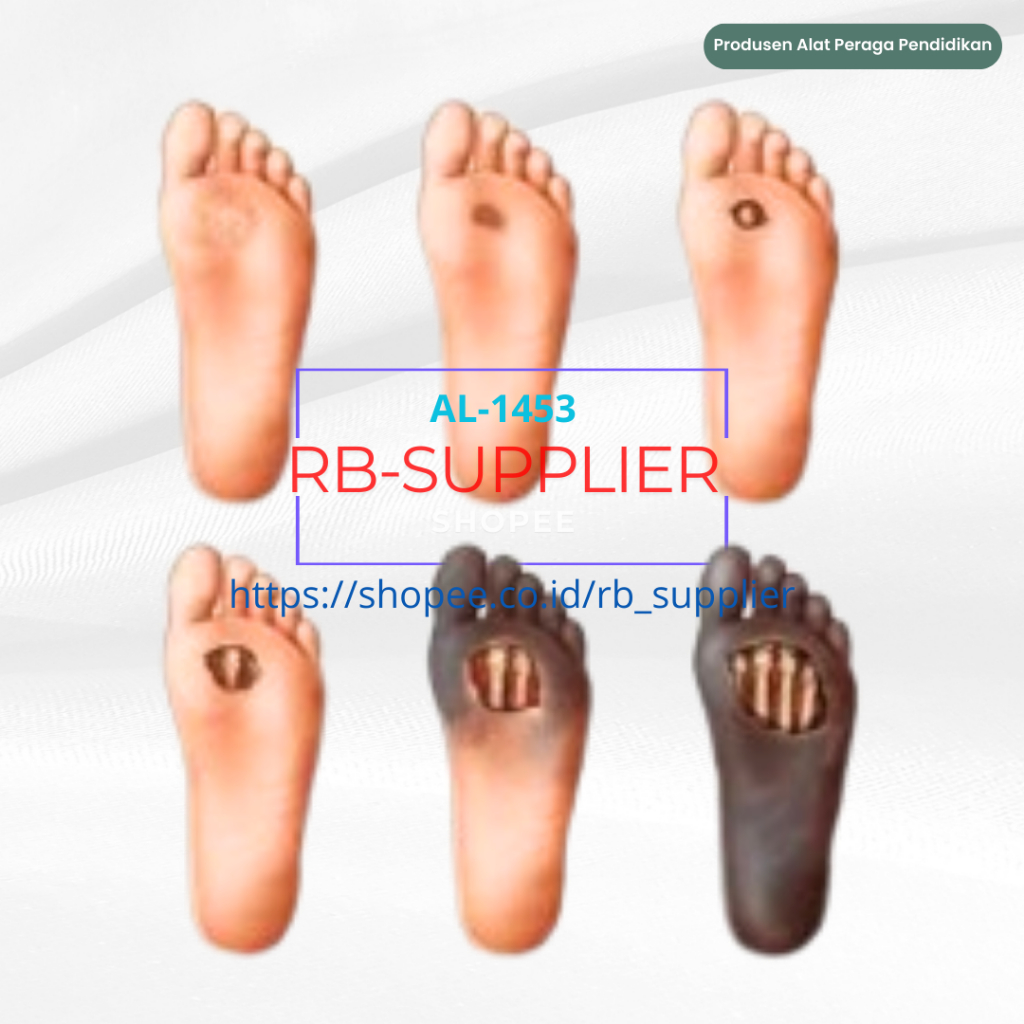 Jual Ulkus Dekubitus-Manikin/Manekin Model Kaki Luka Decubitus/Luka ...
