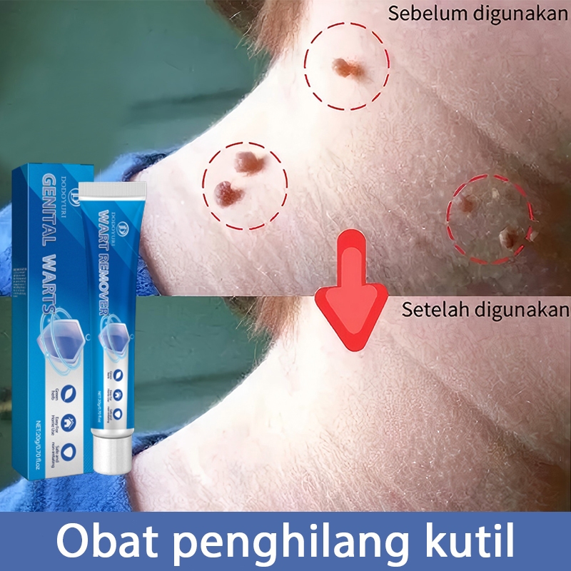 Jual Obat kutil obat lalat obat penghilang kutil penghilang kutil dan ...