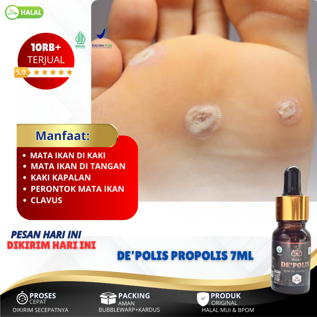 Jual Obat Mata Ikan di Telapak Kaki, Perontok Mata Ikan di Telapak Kaki, Kapalan Di Kaki, Mata ...