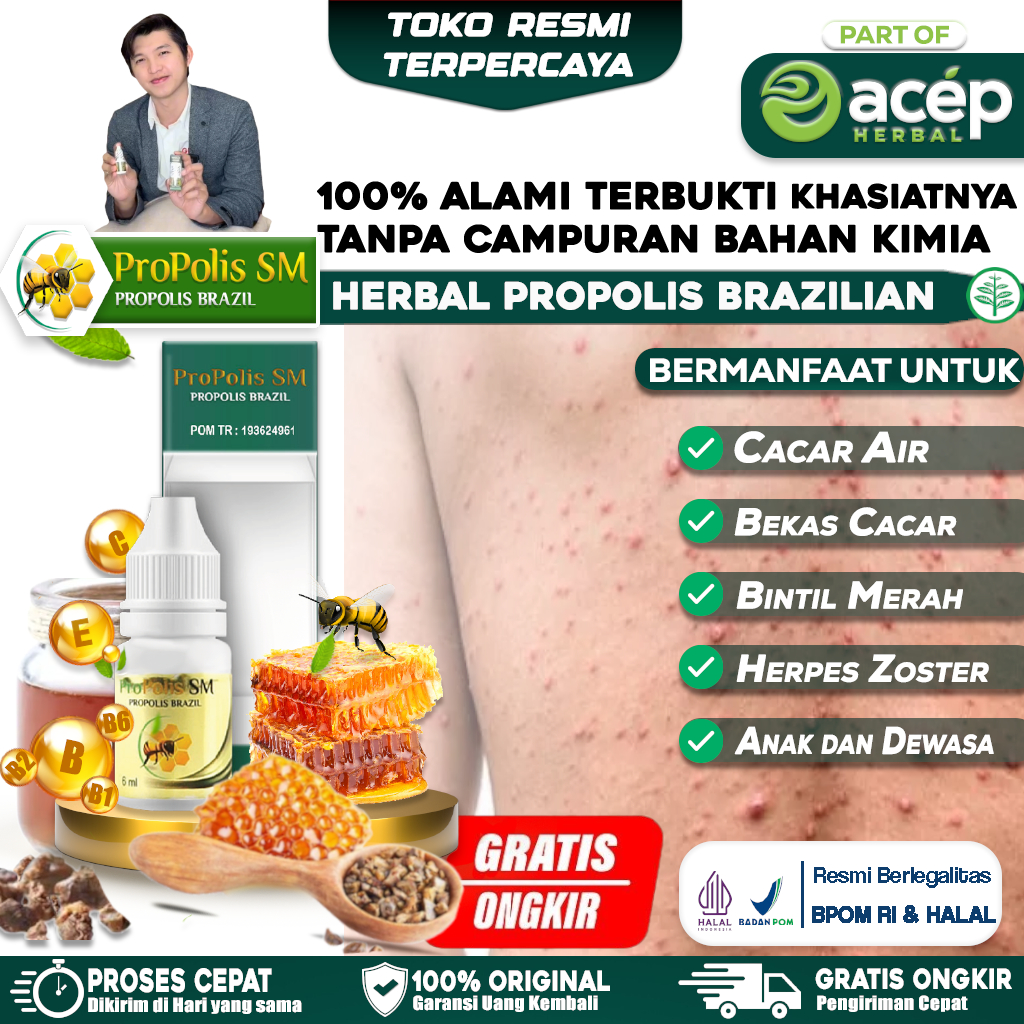Jual Obat Cacar Bekas Cacar Masalah Kulit Gatal Bintik Merah Berair 100 ...