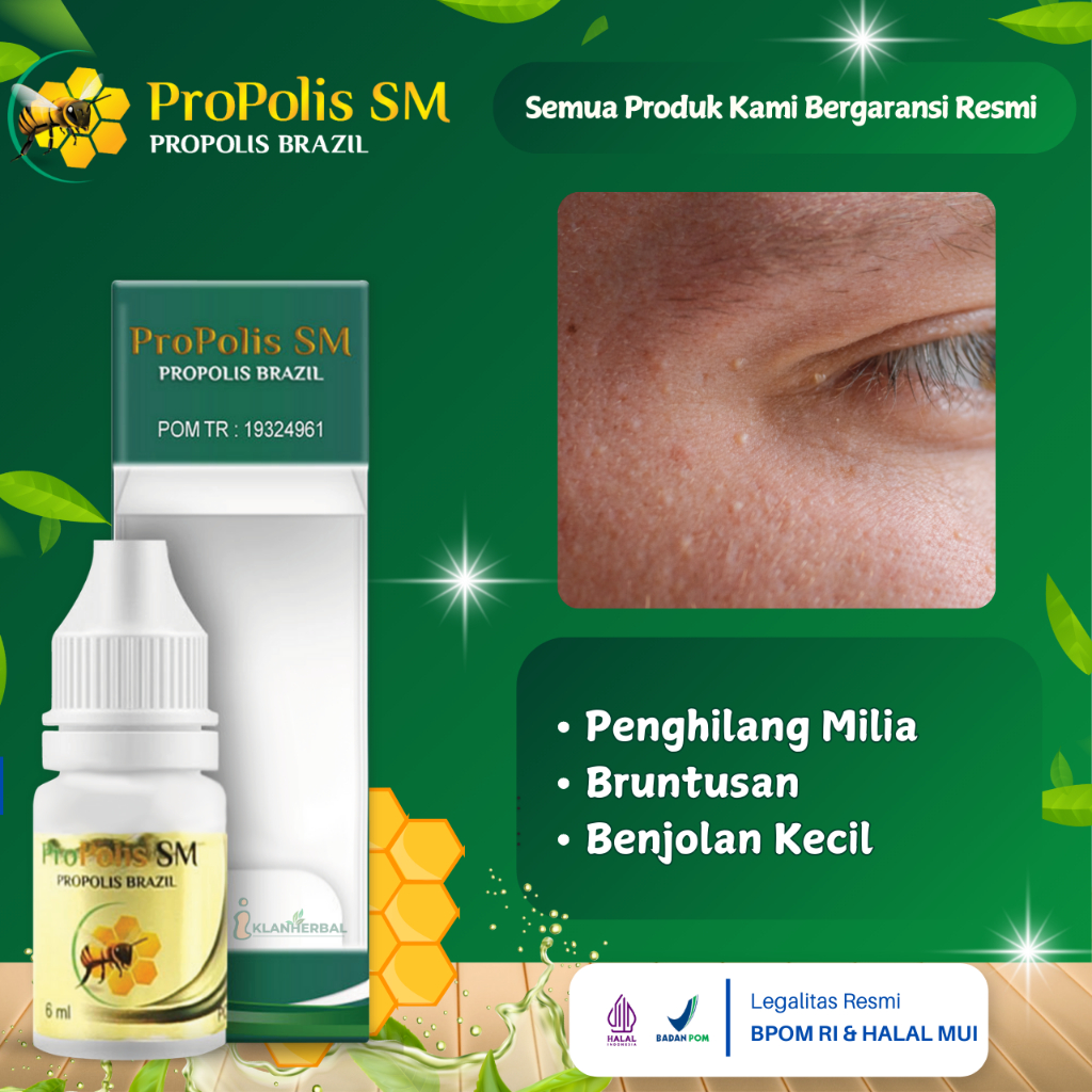 Jual Obat Penghilang Milia Di Bawah Mata Pada wajah Di Kelopak Mata ...