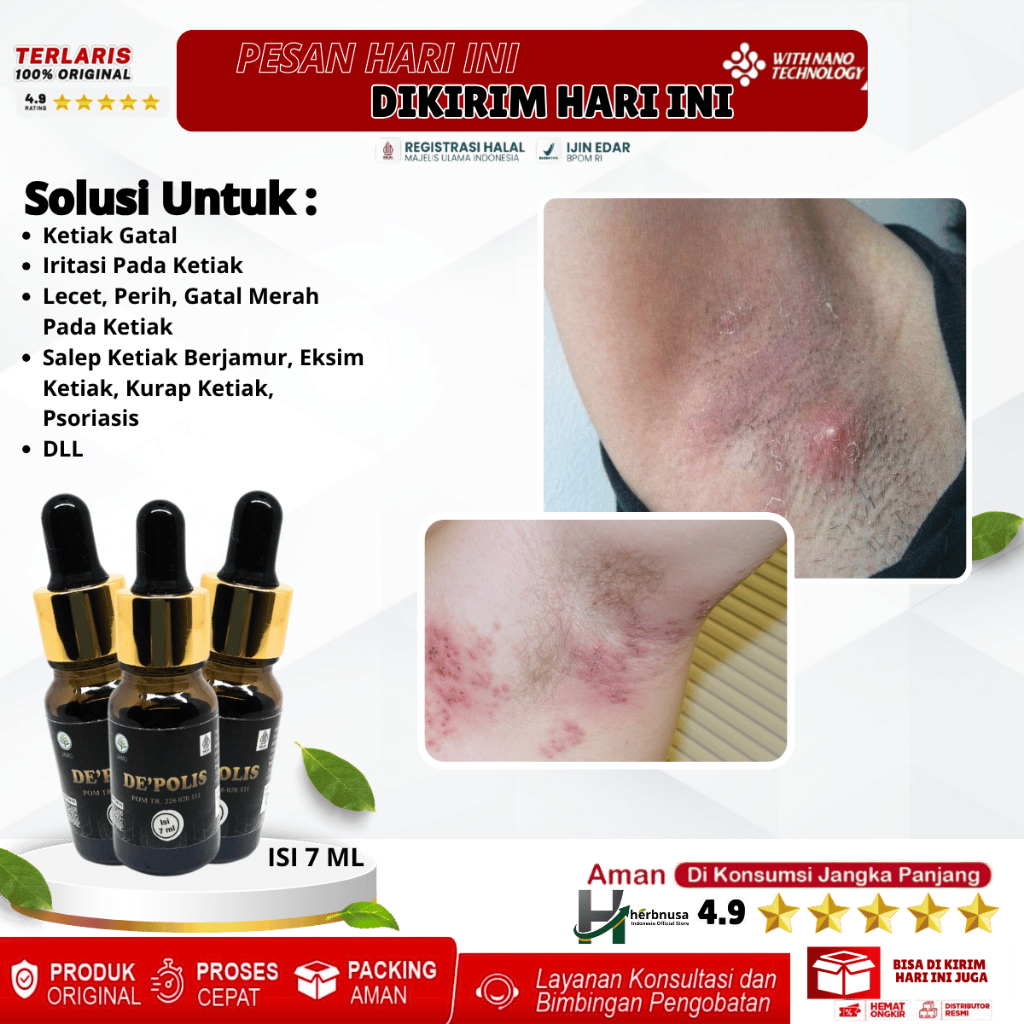 Jual Obat Ketiak Gatal, Iritasi Pada Ketiak, Lecet, Perih, Gatal Merah ...