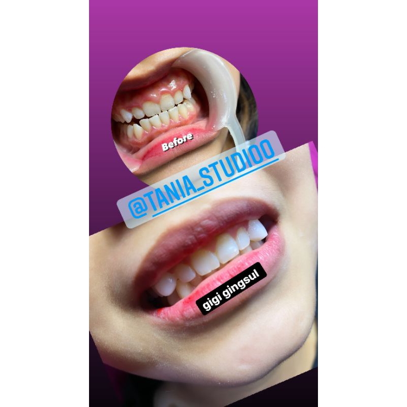 Jual Veneer Gigi Gingsul Porcelain | Shopee Indonesia