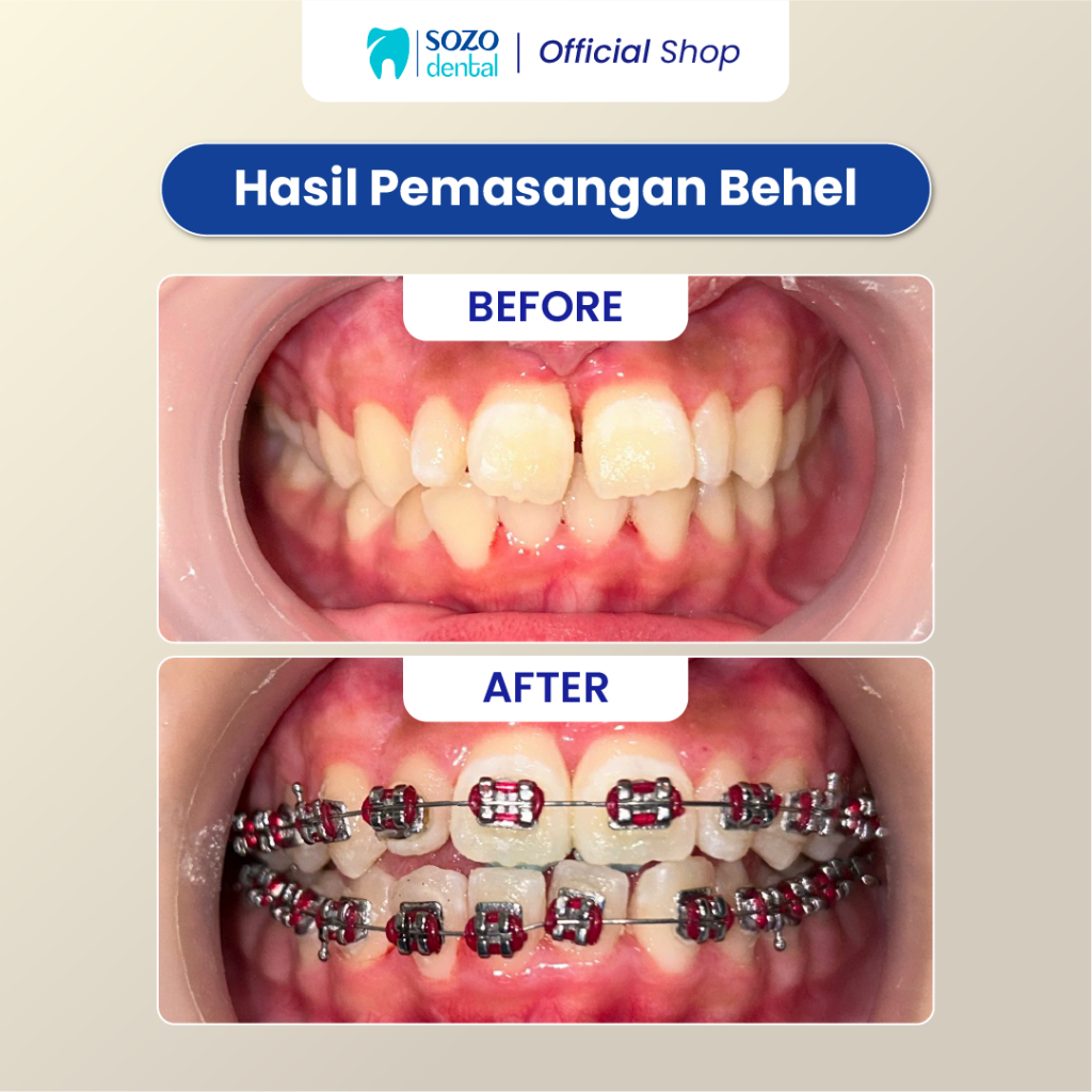 Jual Paket Behel Metal Basic Komplit: Pemasangan Rahang Atas dan Bawah ...