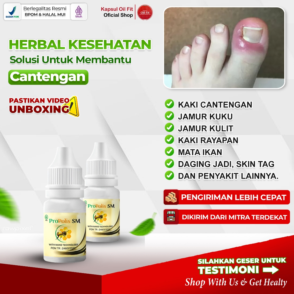 Jual Obat Cantengan Kuku Jempol Kaki Bengkak Sakit Bau Busuk Karna ...