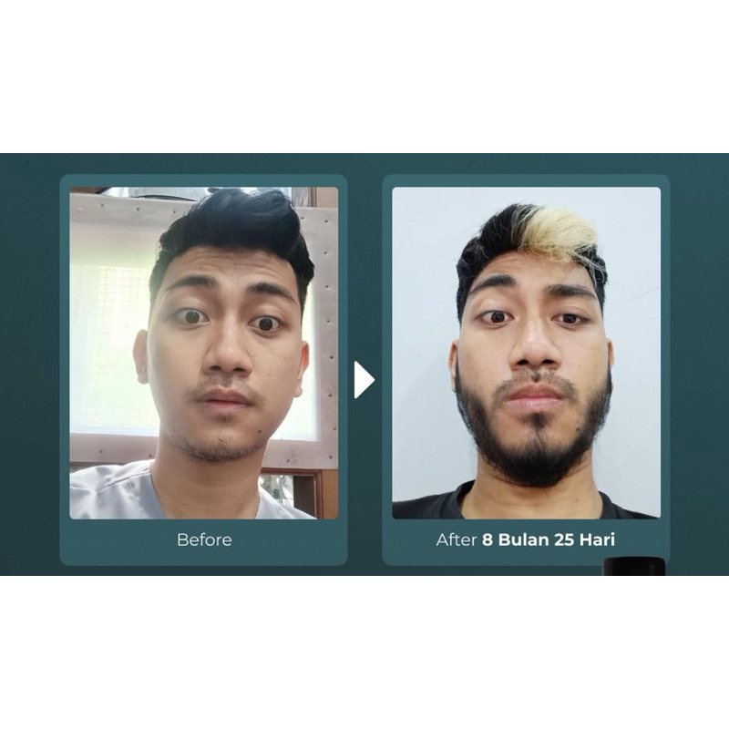 Jual BEST SELLER TERMURAH TERLARIS KEMASAN BARU NEW PACK MINOXIDIL MADE ...