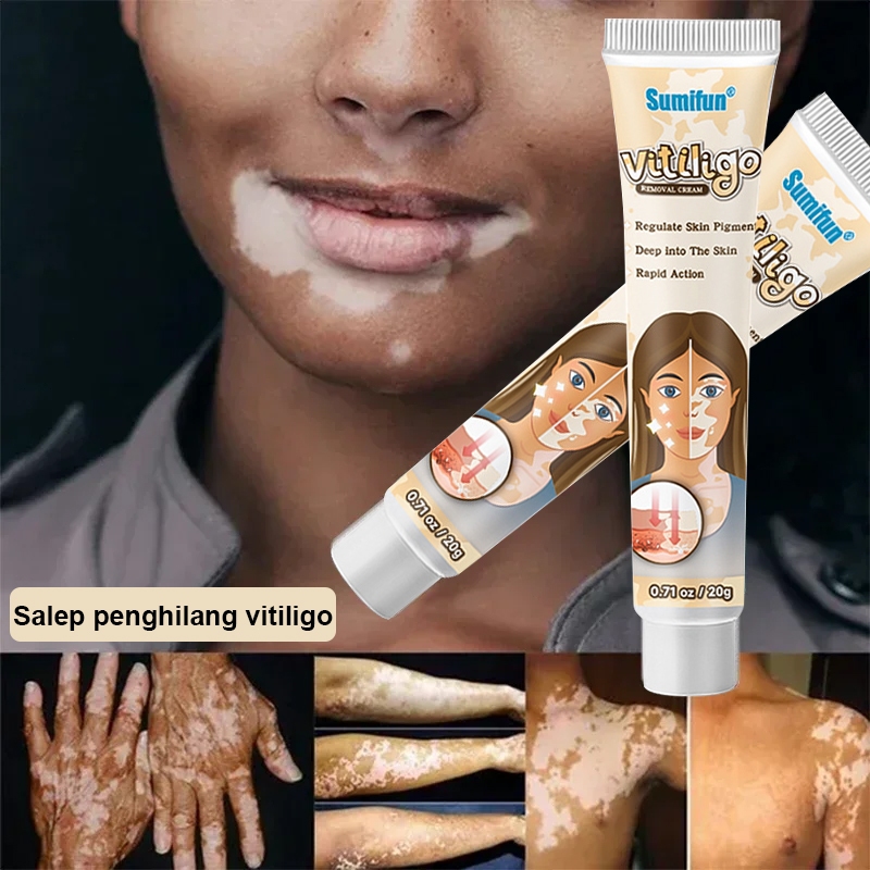Jual Salep vitiligo obat vitiligo paling ampuh 20g - khusus untuk ...