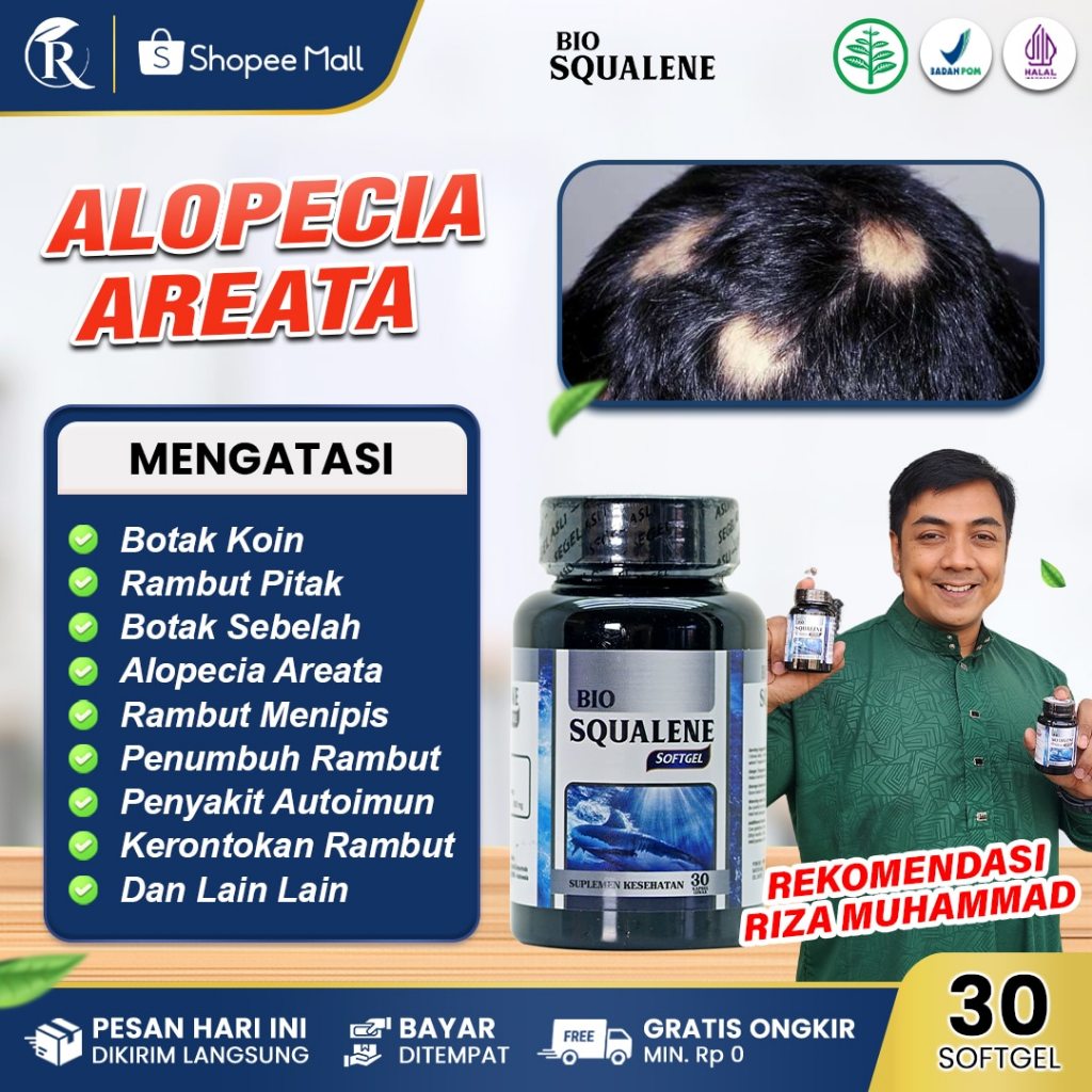 Jual Obat Alopecia Areata, Botak Koin, Rambut Pitak, Penumbuh Rambut ...