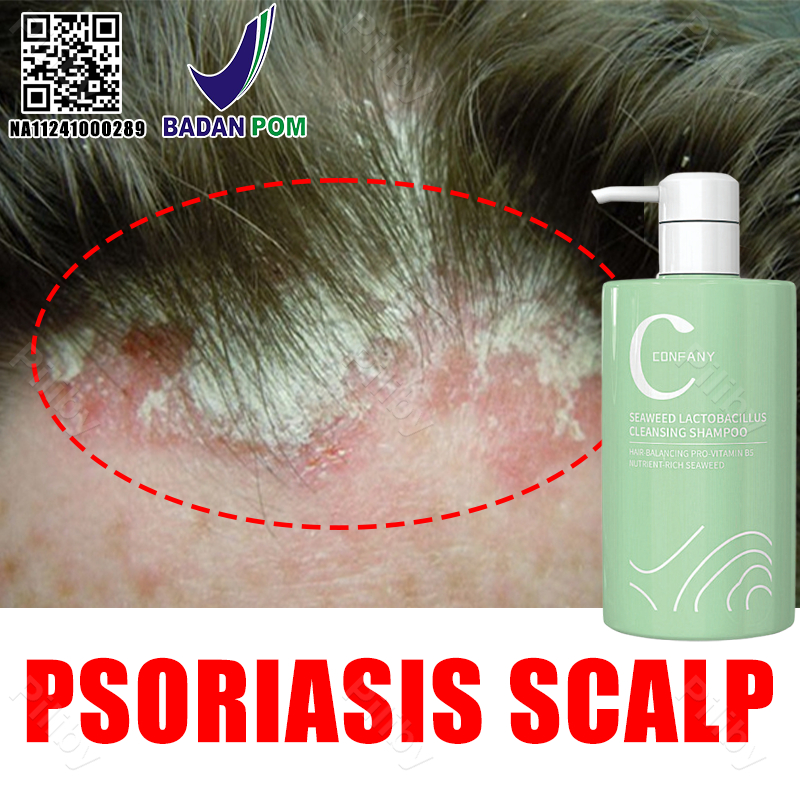 Jual shampoo anti ketombe dan gatal Penghilang ketombe berkerak dan gatal psoriasis shampoo ...