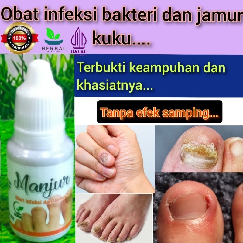Jual Obat Kuku Cantengan jamur kuku infeksi bakteri bernanah bau gatal ...