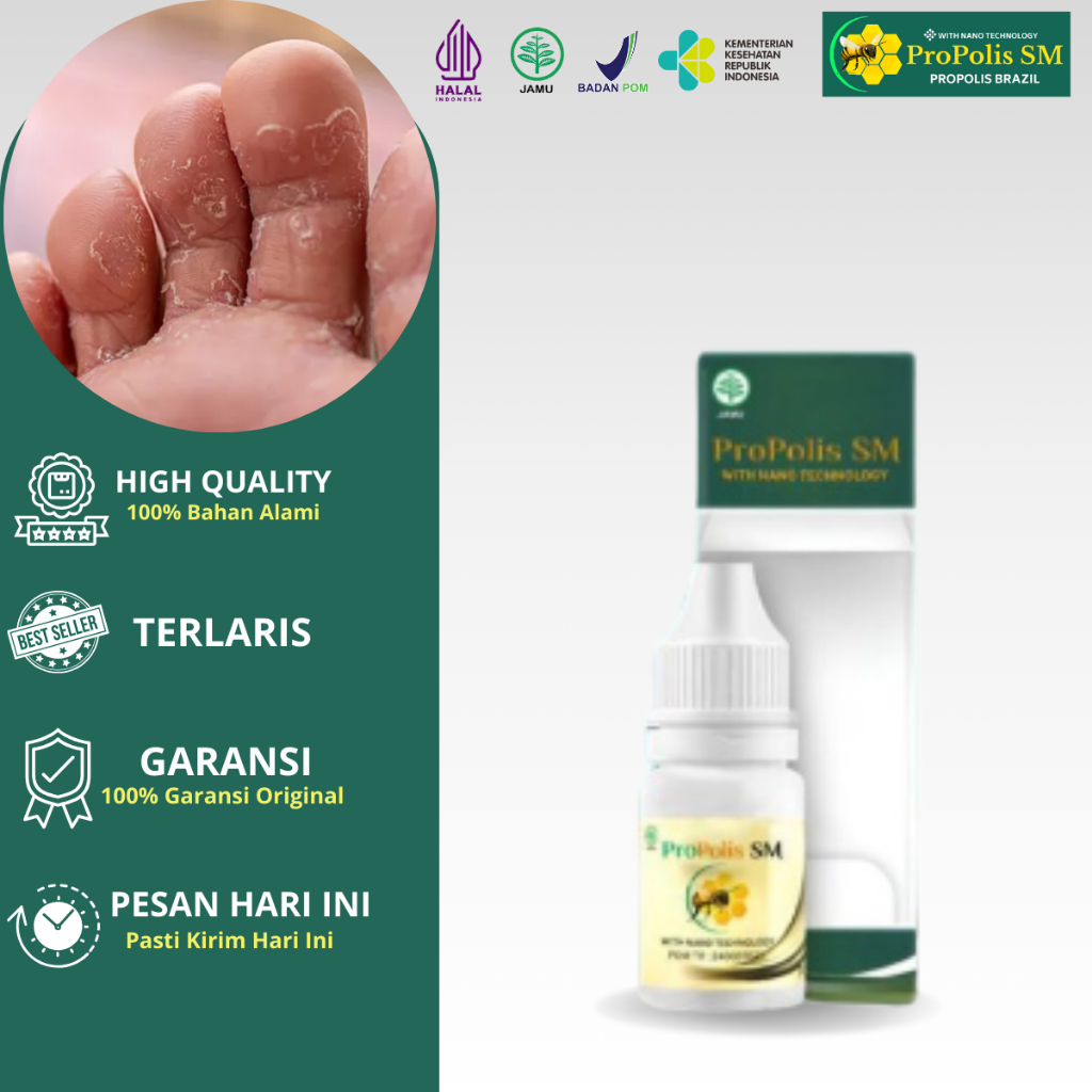 Jual Obat Kutu Air Untuk Kaki Bersisik Kaki Rayapan Pecah Budug Bintik ...