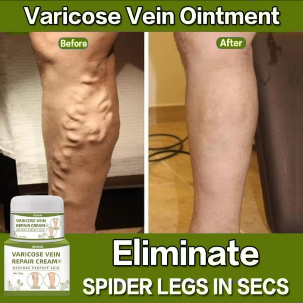 Jual ORI SOUTH MOON VS EELHOE Krim Varises Semprotan Varises Mengurangi ...