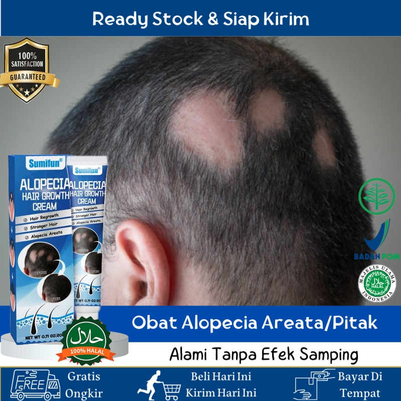 Jual Obat Pitak, Obat Alopecia Areata, Obat Botak Koin, Obat Rambut ...