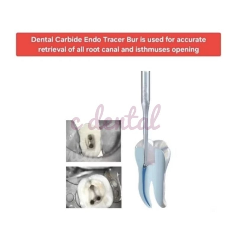 Jual Dental Endo Tracer Metal Bur Opening Orifice Access Finder Hidden ...