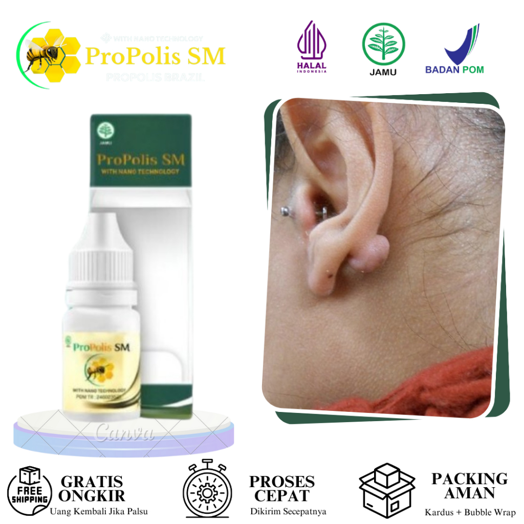 Jual Obat Keloid Luka Tindik, Daging Tumbuh Di Telinga, Infeksi Luka ...