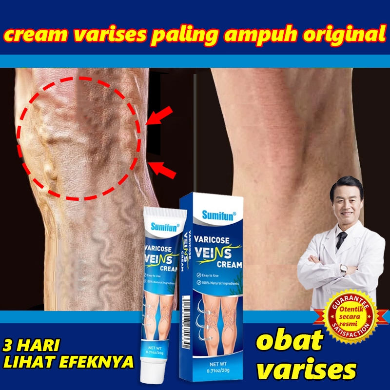 Jual obat varises veins cream varises paling ampuh original obat ...