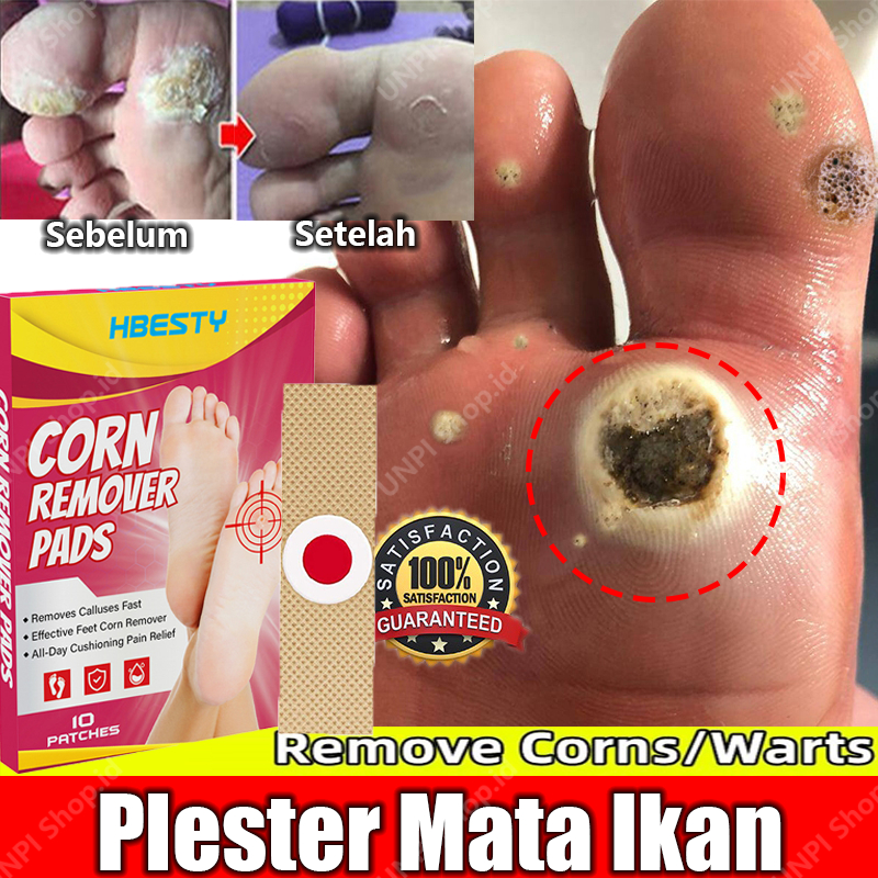 Jual Plester Mata Ikan Paling Ampuh Obat Mata Ikan Penghilang Mata Ikan ...