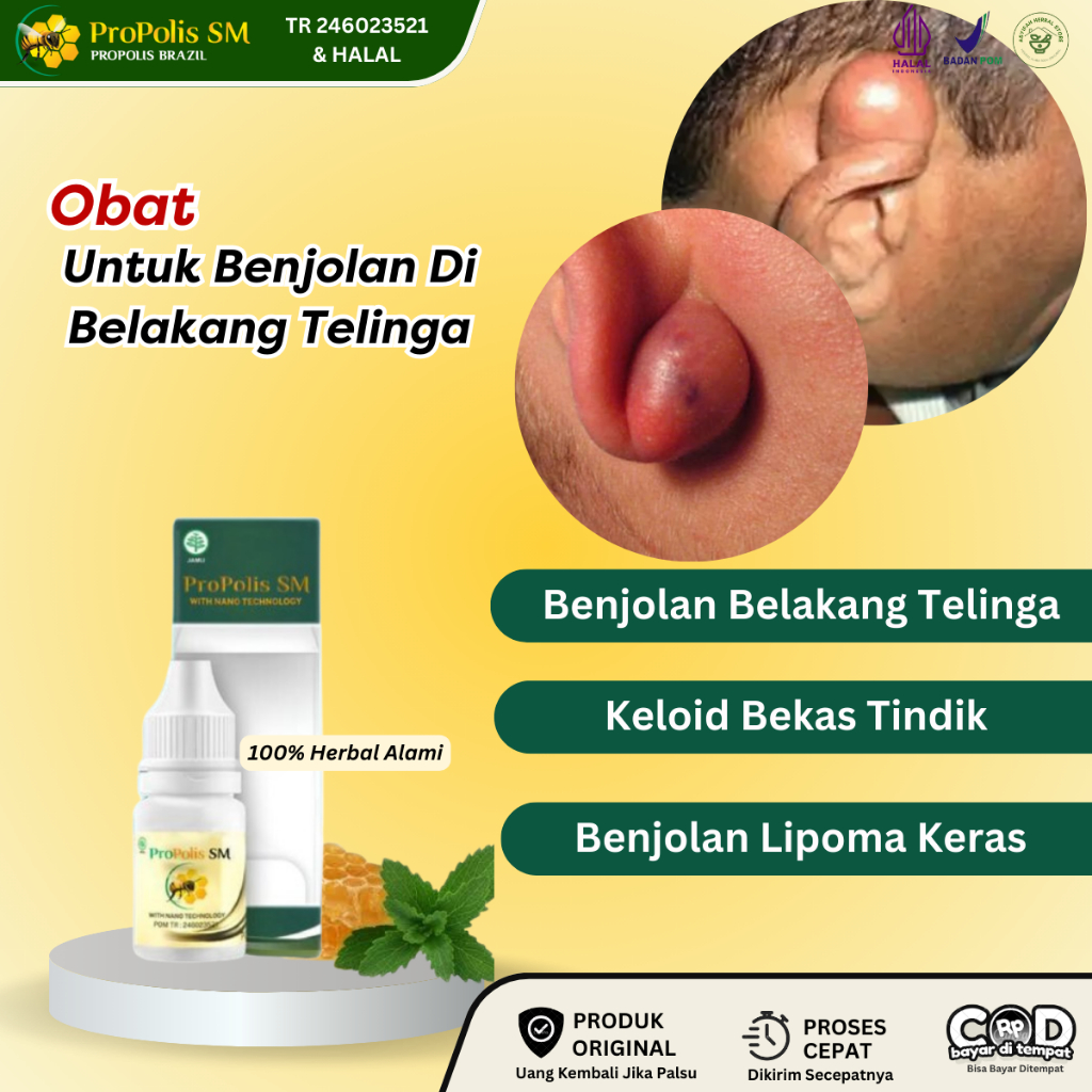 Jual Obat Benjolan Di Belakang Telinga, Benjolan Di Daun Telinga, Obat Keloid Di Telinga Bekas ...