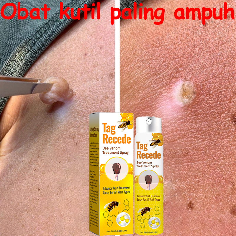 Jual Penghilang tahi lalat di wajah Penghilang kutil di leher Wart ...