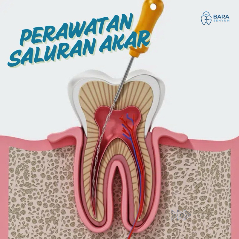 Jual Perawatan Saluran Akar Gigi | Shopee Indonesia