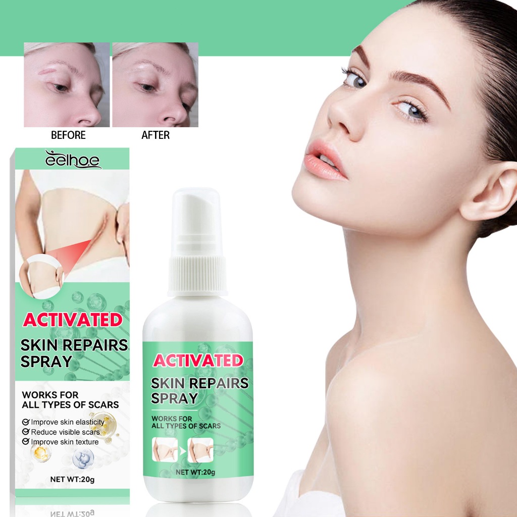 Jual Scar Remover Spray Stretch Marks Permanent Removal Burn Surgery ...
