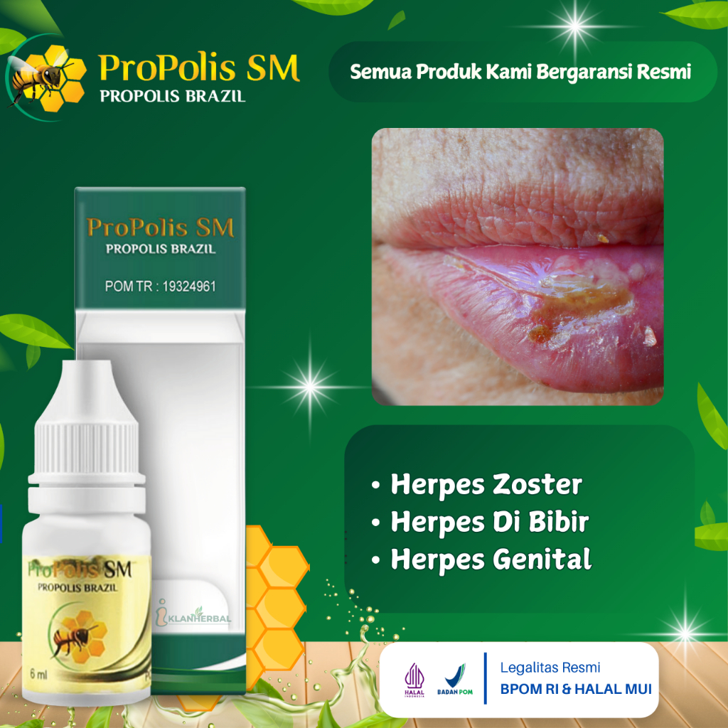 Jual Obat Herpes Kulit Zoster Di Bibir Simplex Genital Kelamin Gatal ...