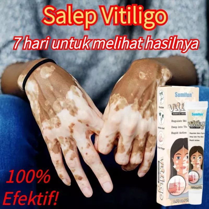 Jual Salep khusus untuk vitiligo 20g vitiligo/penyakit kulit putih/panu ...