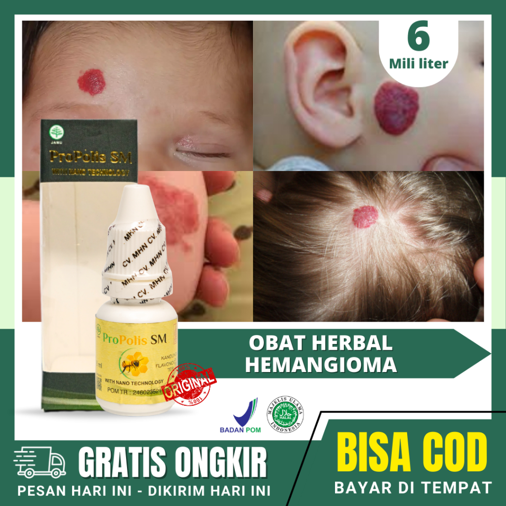 Jual Obat Hemangioma Tumor Hemangioma Penghilang Tanda Lahir Merah ...