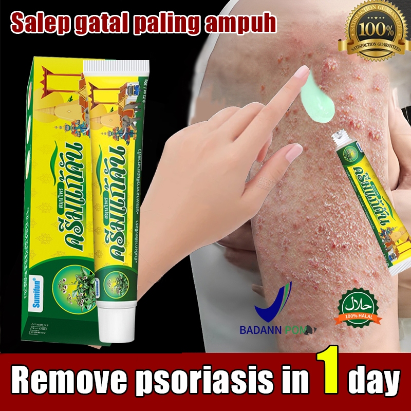 Jual Salep gatal paling ampuh 20g obat gatal obat eksim salep gatal ...
