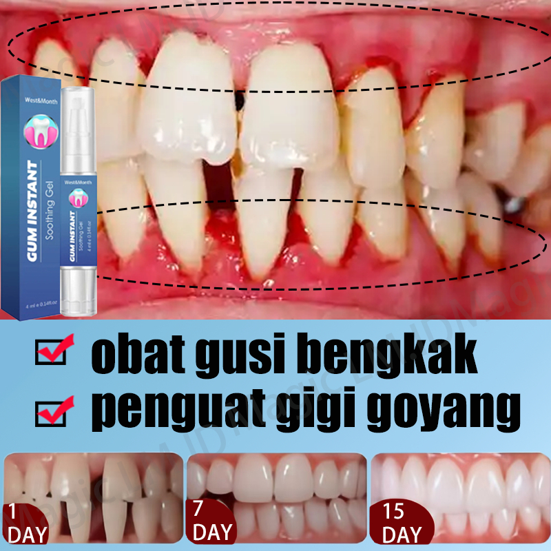 Jual gumshield obat gusi bengkak penguat gigi goyang obat sakit gusi ...