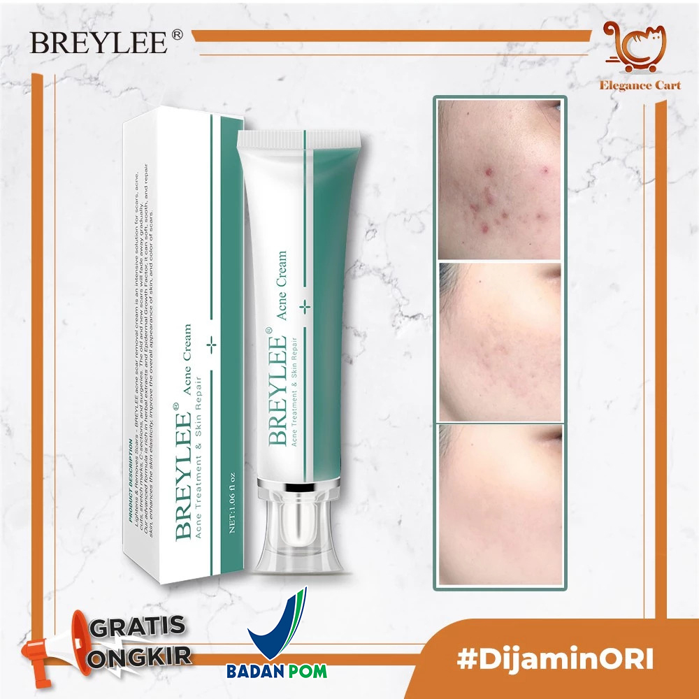 Jual [PROMO] BREYLEE Acne Scar Removal - Acne Scar Removal Cream Skin Repair Scar Acne Treatment ...