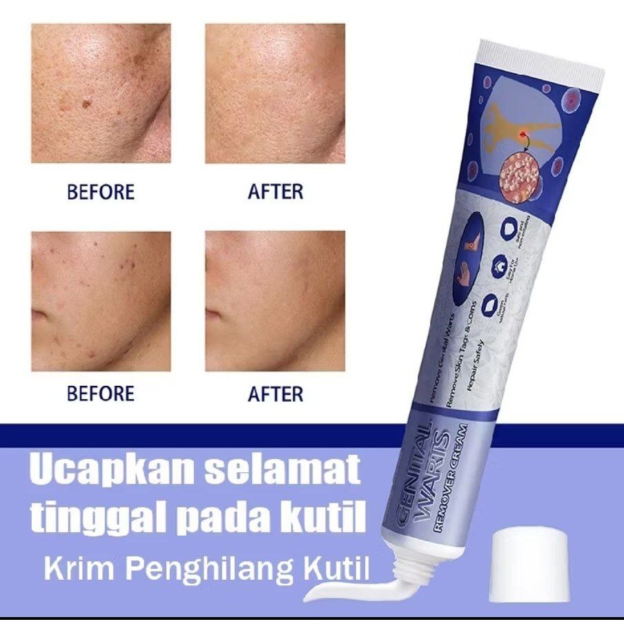 Jual Obat kutil kelamin Pria / Wanita Penghilang Kutil Kelamin、Obat ...