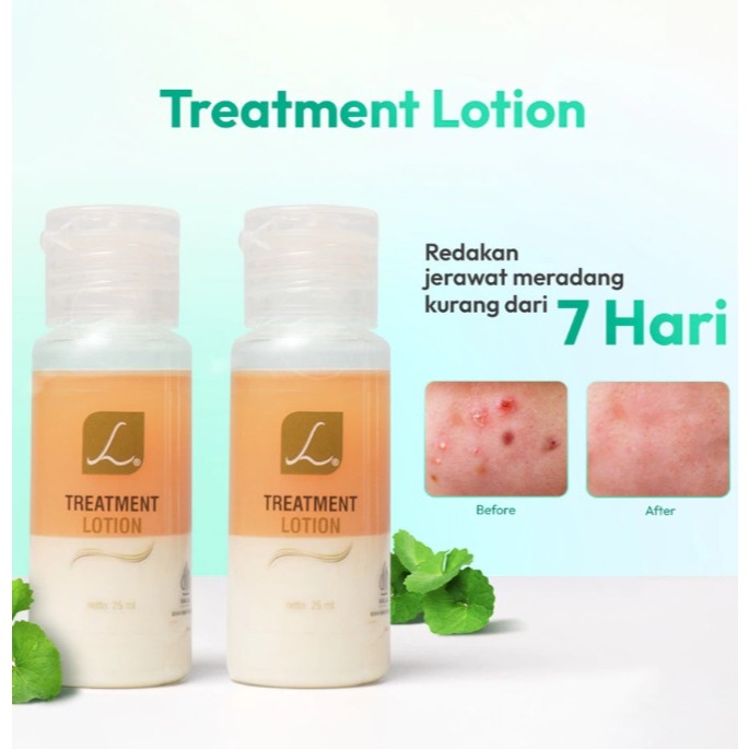 Jual Larissa Treatment Lotion - Totol Jerawat untuk JERAWAT MERADANG/MEMBANDEL/PARAH, Kering ...