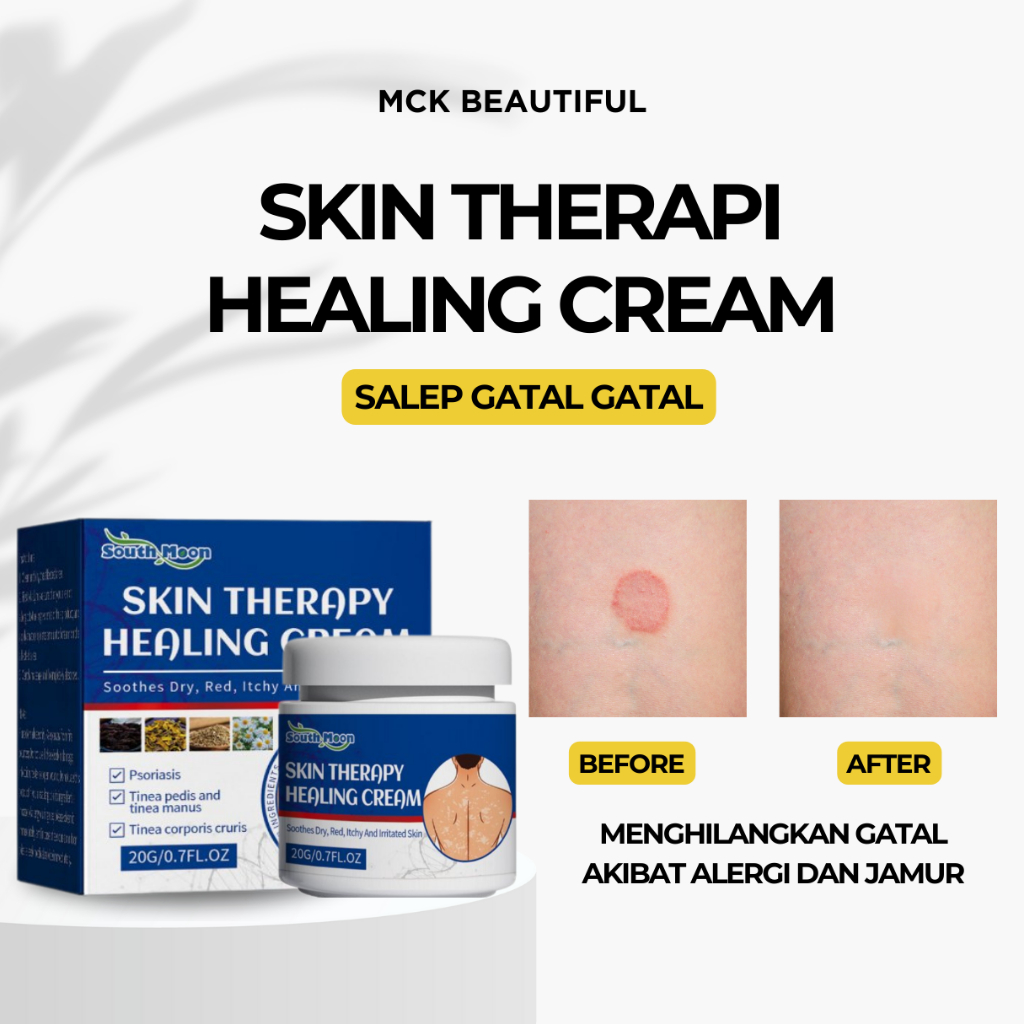 Jual South Moon Skin Therapy Healing SKIN ANTI-ITCH CREAM Salep gatal ...