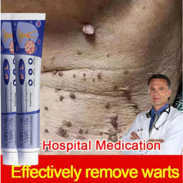 Jual Obat Kutil Pengilang Kutil Dan Tahi Latat Salep Kutil Skin Tag ...