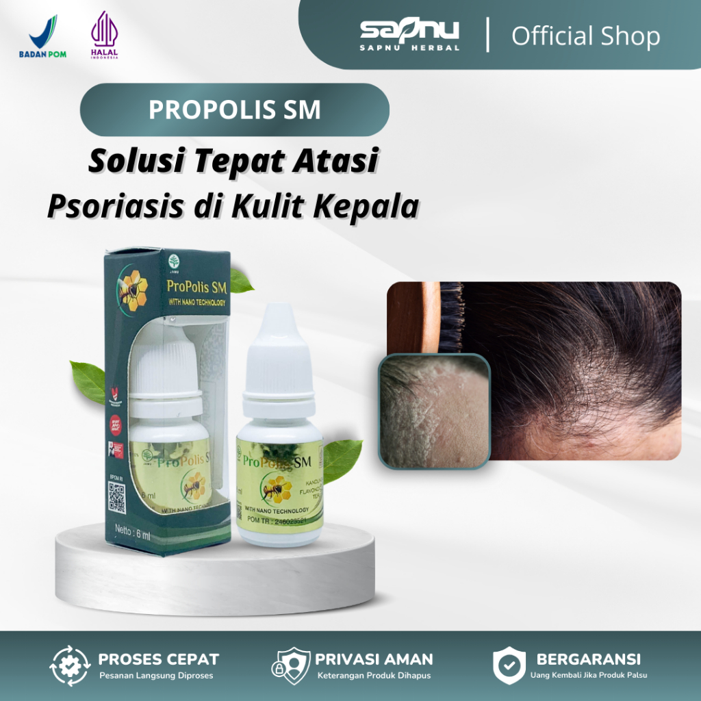 Jual Obat Psoriasis di Kepala, Kulit Kepala Berkerak, Ketombe Parah, Gatal Kulit Kepala, Jamur ...