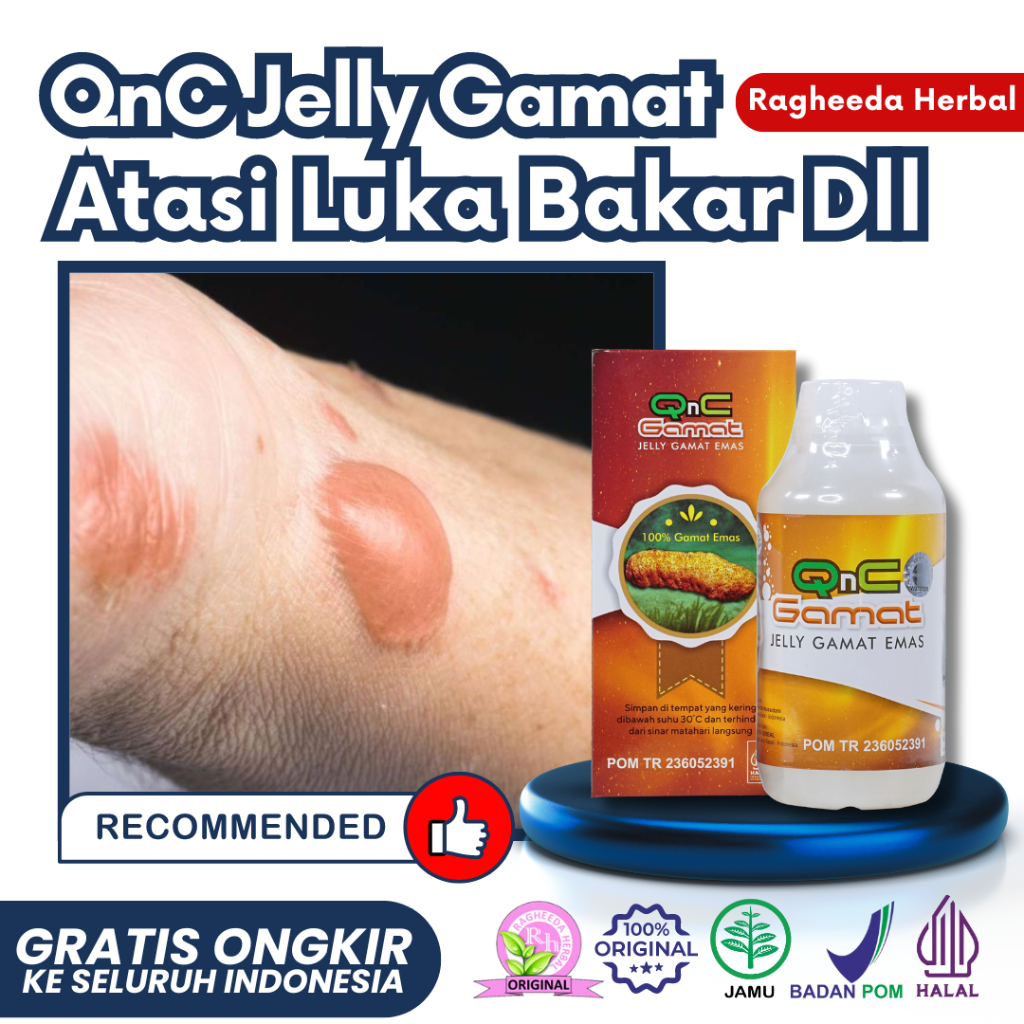 Jual Obat Luka Bakar - Luka Tersengat Listrik - Kesetrum - Luka ...