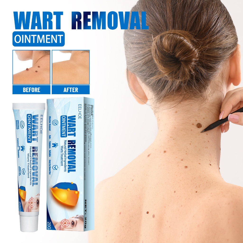 Jual Krim penghilang kutil/kutil filiform/cocok untuk tangan, kaki ...