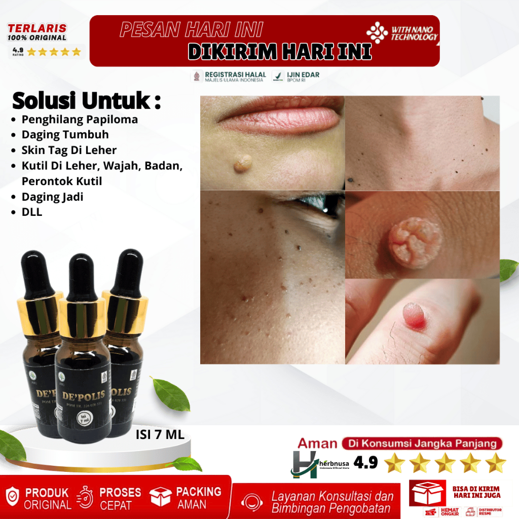 Jual Obat Penghilang Papiloma, Penghancur Daging Tumbuh, Obat Skin Tag ...