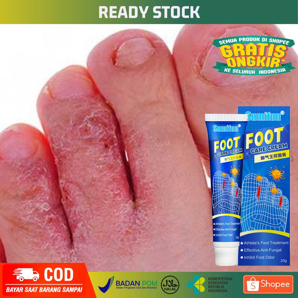 Jual Obat Tetes Bau Kaki - Telapak Kaki Bolong / Kaki Rayapan - Salep ...