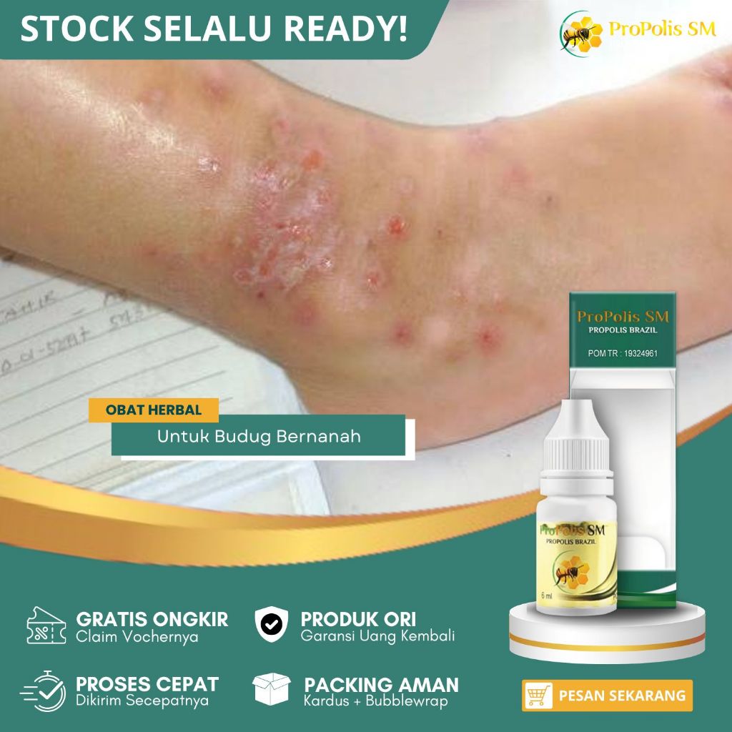 Jual Obat Budug Bernanah, Gatal Bernanah, Cenang Telapak Kaki, Gatal ...